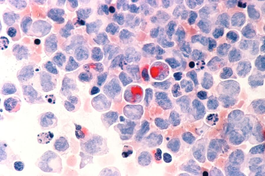 Gene-mutation pathway discovery paves way for targeted blood cancers ...